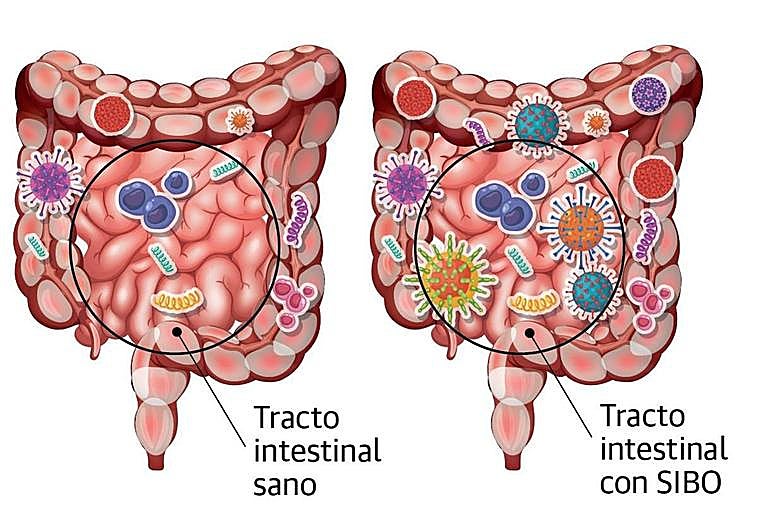 SIBO: qué es, cómo afecta y de qué forma se trata | La Verdad